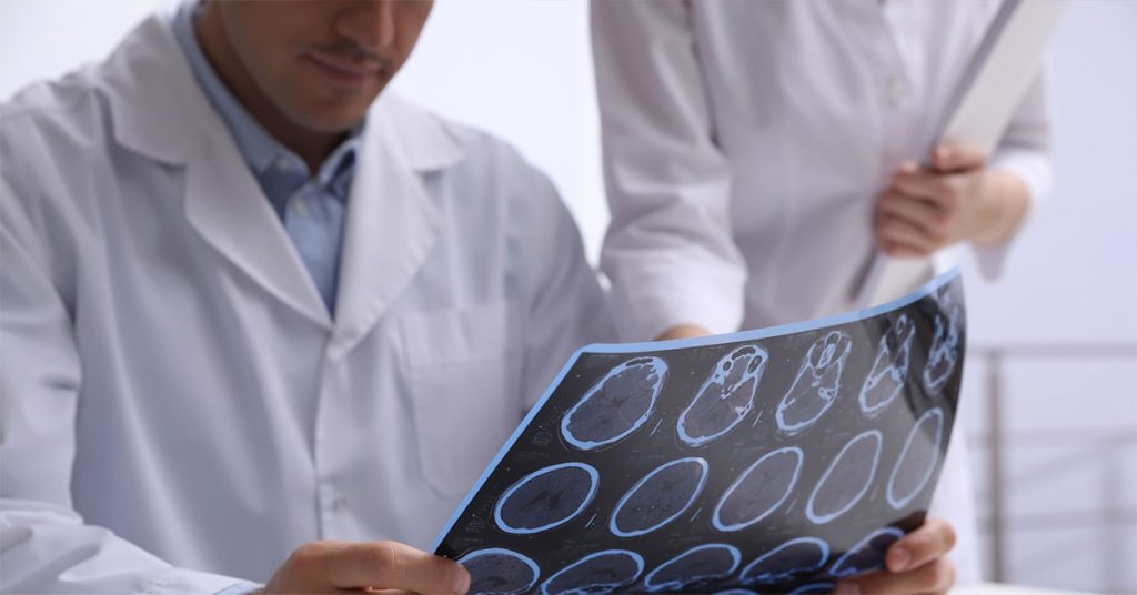 Epilessia: tutto quello che c'è da sapere e come comportarsi